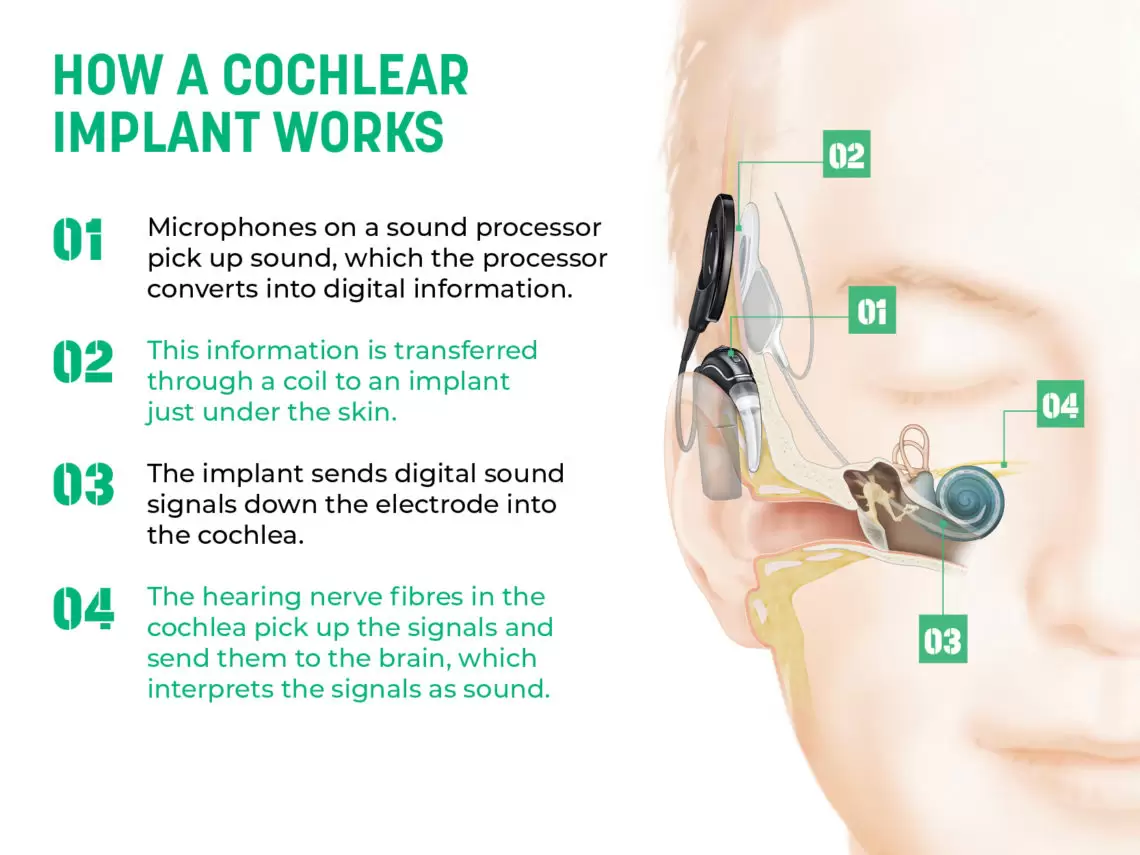 The Cochlear implant: What's next for one of Australia's most famous ...
