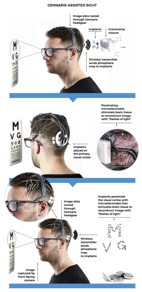 The Australian team bringing bionic vision into focus - create digital