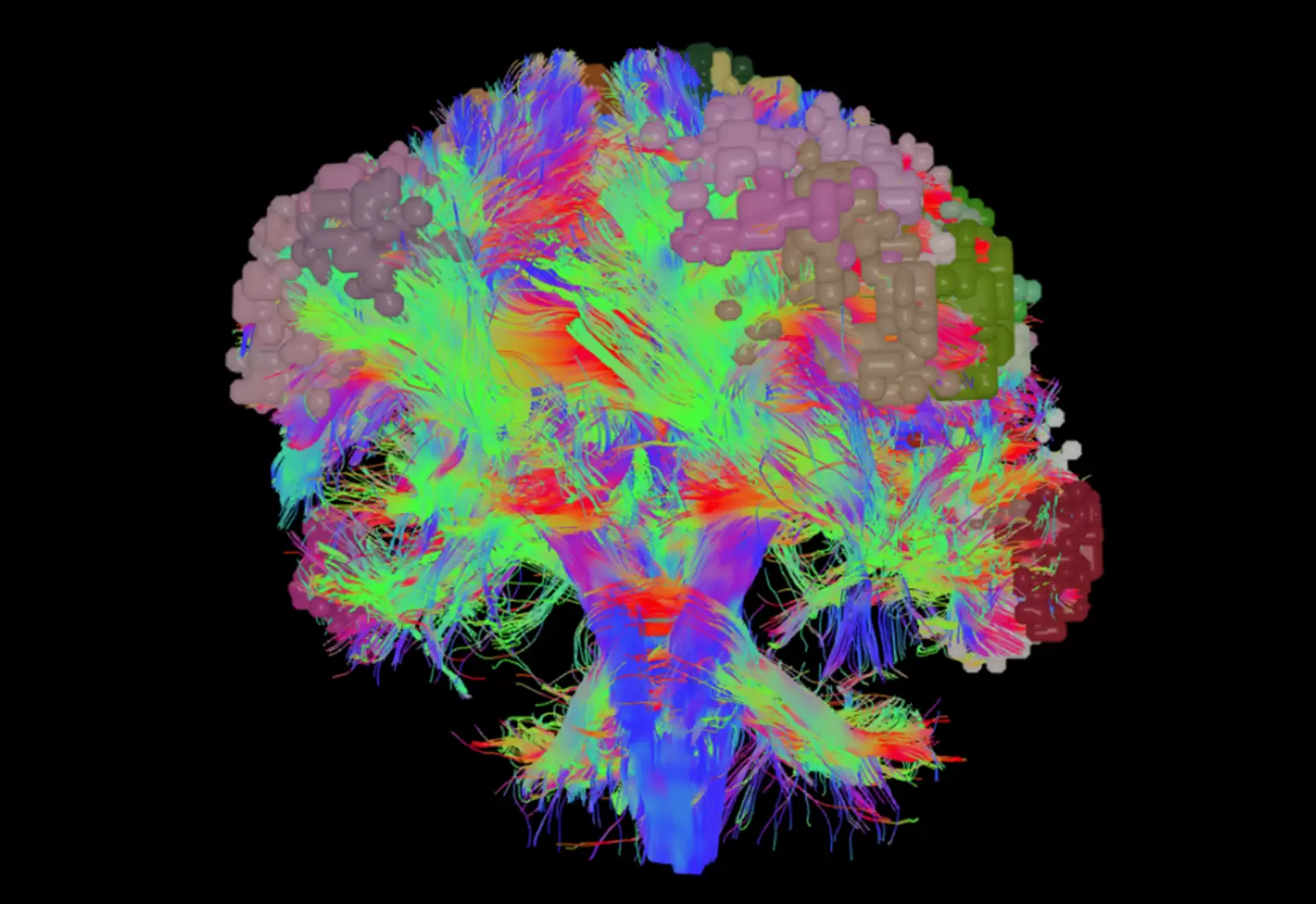 The AI-powered brain map leading to better neurosurgery outcomes ...