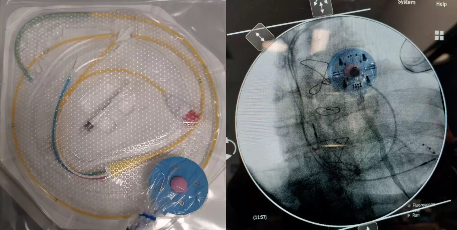 SaiiV-ing lives: This non-invasive heart failure monitoring device is ...